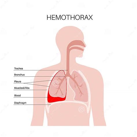Hemothorax Medical Poster Stock Vector Illustration Of Respiratory 276458753