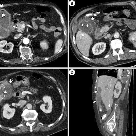 Surgeons Treatment Preferences Of Acute Calculous Cholecystitis Before