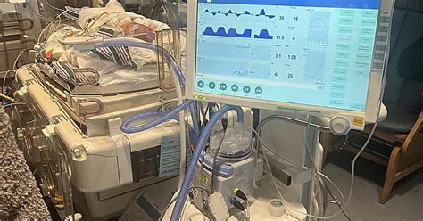 Conventional Ventilator Album On Imgur