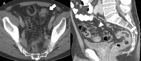 Rectosigmoid Colitis Without Diverticulosis 62 Year Old Male With Download Scientific Diagram