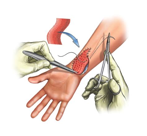 How Skin Grafts Work How It Works