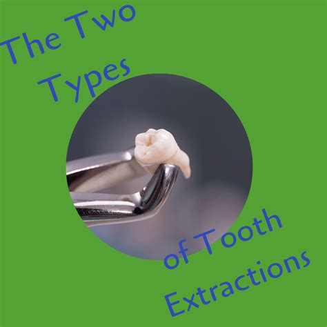 The 2 Types Of Tooth Extractions Tulsa Precision Dental