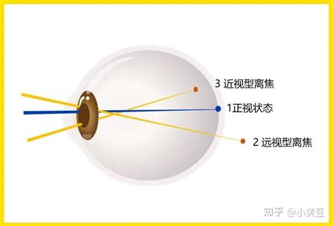 近视防控之离焦镜片小乐园 知乎