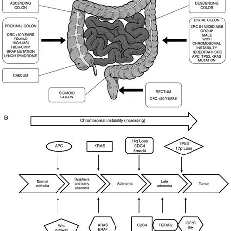 A Anatomical Subtypes Of Colorectal Cancer And Their Associations