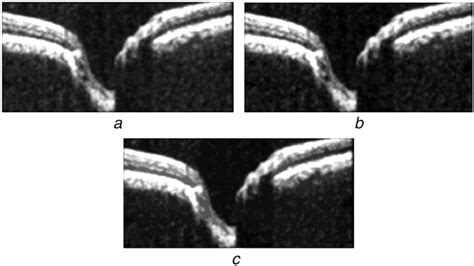Image Denoising And Enhancement A Median Filter Applied On The Added