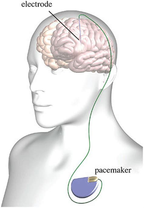 What Is Deep Brain Stimulation Dbs Jagtap Clinic And Research Centre