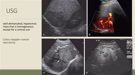 Benign Hepatic Masses Ppt