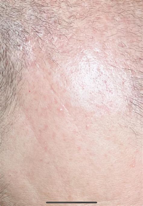 Post Accutane Tiny White Pustules And Red Spots On Forehead What Is It Rfolliculitis