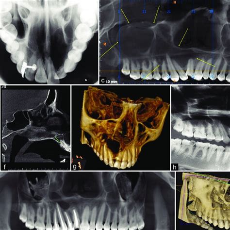 Pdf The Role Of Cone Beam Computed Tomography In Evaluation Of An Extensive Radicular Cyst Of