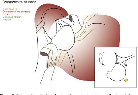 Figure 3 From Coracoid Osteotomy In Anterior Fracture Dislocation With Concomitant Bony Bankart