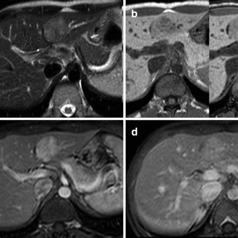 Mri Showing Hnf 1amutated Hepatocellular Adenoma In Segment Vi A Axial