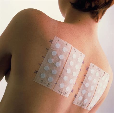 Young Woman With Allergy Test Patches On Photograph By Saturn Stills