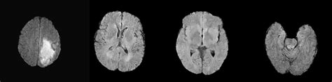 Monai Test Brats Mri Axial Slices Generative Diffusion · Hugging Face