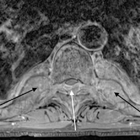 T1 Weighted Sagittal Mri Showing Moderate And Heterogeneous Enhancement