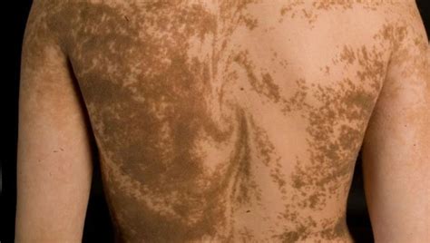 You Have Invisible Zebra Stripes And Theyre Called Lines Of Blaschko