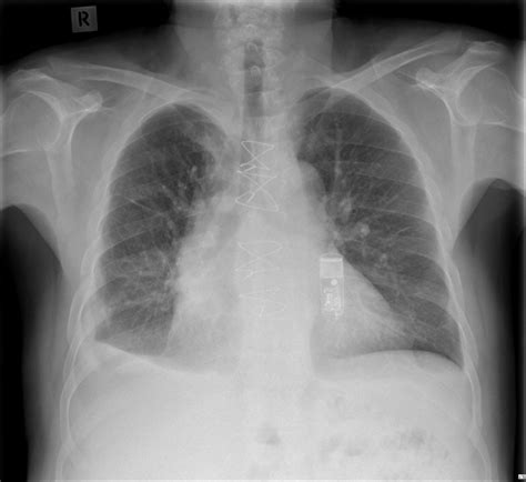 Subpulmonic Pleural Effusion Pacs