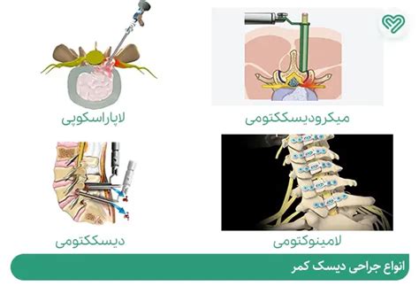 عمل دیسک کمر و بایدها و نبایدهای قبل و بعد از آن