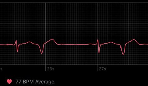 Weird Ekg Not An Artifact Pattern Repeats Throughout Feels Like