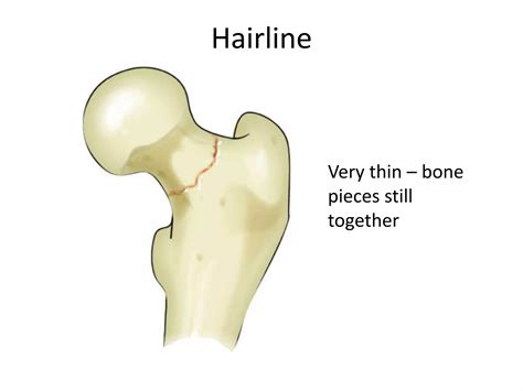 Fracture Coding Cm And Pcs Ppt