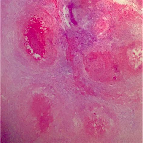 High Power View Microscope Showing Four Schistosome Eggs Having A