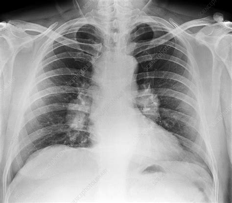 Sarcoidosis Of The Lungs X Ray Stock Image C0387675 Science