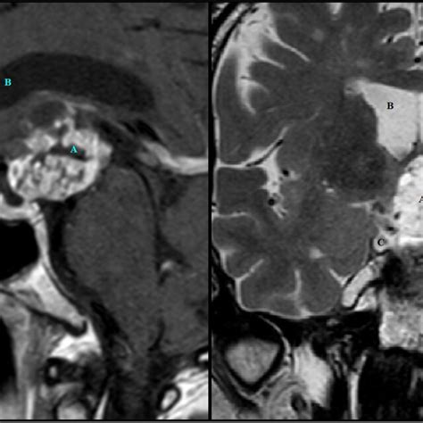 Preoperative Mri Showing An Enhanced Sagittal T1 Weighted And Coronal
