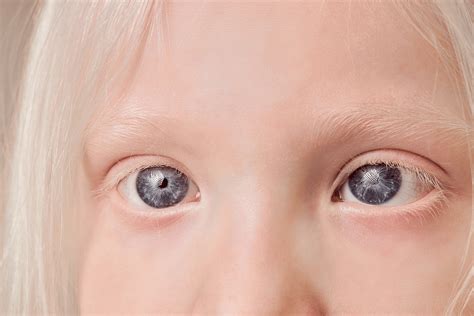 Partial Ocular Albinism