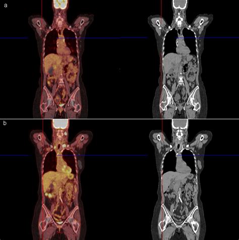 Hypermetabolic Lymphadenopathy Following The Administration Of Covid 19