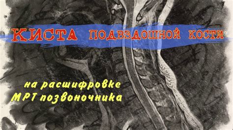 ПОЗВОНОЧНАЯ ГРЫЖА L4 L5 КИСТА подвздошной кости и грыжа L3 L4 на РАСШИФРОВКЕ МРТ позвоночника