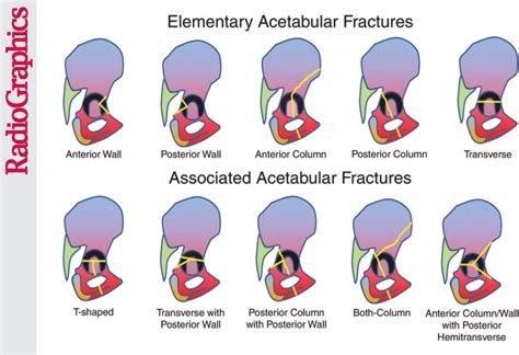 Figure 3 From Acetabular Fractures What Radiologists Should Know And