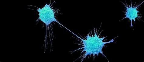 Transform Trial Looks To Fine Tune Prostate Cancer Screening Oncology Central