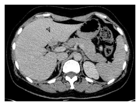 Segmentation Example Necessary Reprocessing For Pancreas Segmentation
