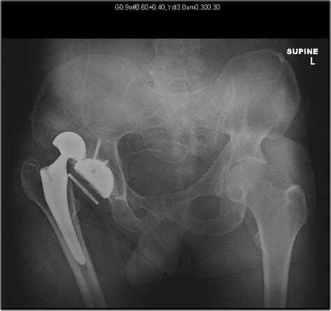 Closed Reduction Of A Dislocated Constrained Total Hip Arthroplasty