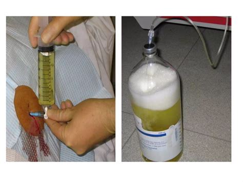 хэвлийн хөндийд хатгалт хийх Pptx