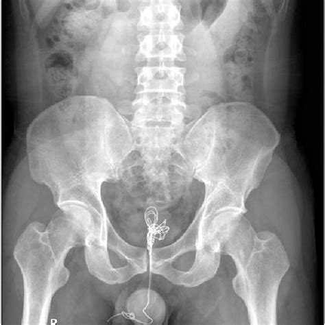 Pelvic X Ray Shows A 3 Cm Radiopaque Foreign Body Download