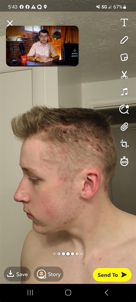 Another Scalp Psoriasis Transition R Psoriasis