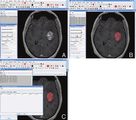 Semiautomated Method For Segmentation Of Enhancing Tumor Tissue Using Download Scientific