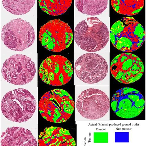 Tissue Microarray Construction A Donor Tissue Blocks Are Selected B Download Scientific