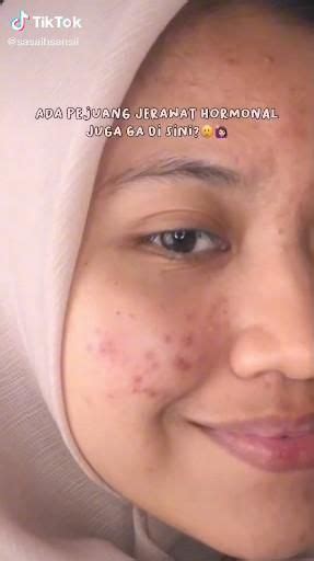 Get Rid Of Pimples Artofit
