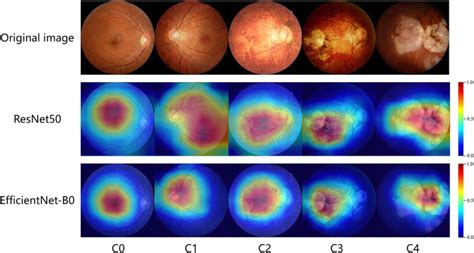 Effective Automatic Classification Methods Via Deep Learning For Myopic