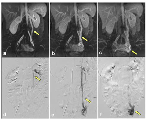 Application Of Differential Subsampling With Cartesian Ordering In Evaluating Left Ovarian