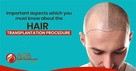 Important Aspects Which You Must Know About The Hair Transplantation