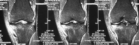 Bicompartmental Knee Makoplasty Robotic Partial Knee Replacement Hc