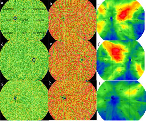 Representative Maps Of Choriocapillaris Density Adg Large Vessel