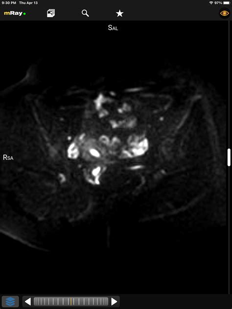 Mri Abnormal Uterus Rmedicaladvice