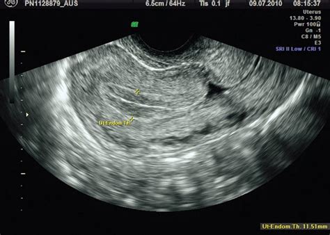 Obsandgyn Management Of Delivery Of Woman With Prior Caesarean Section