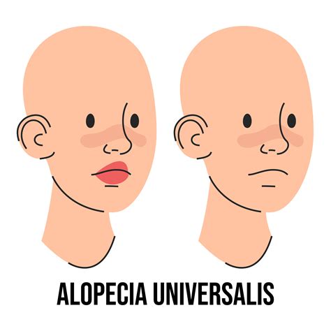 Understanding Alopecia Universalis Wfla