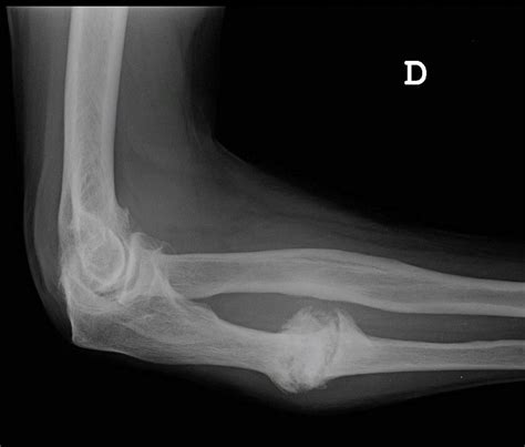 Pseudoartrosis Imagen Radiologica