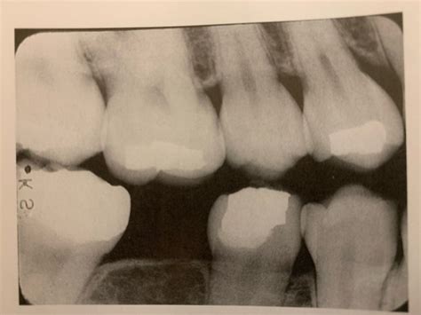 Chapter 20 Exposure And Technique Errors Flashcards Quizlet