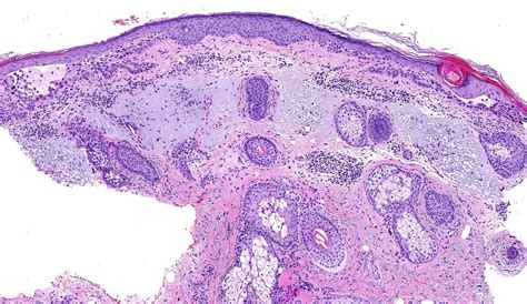 Actinic Keratosis Lip Histology Usmle Reddit